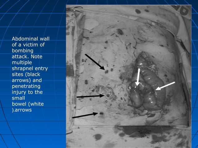 Blast injuries | PPT