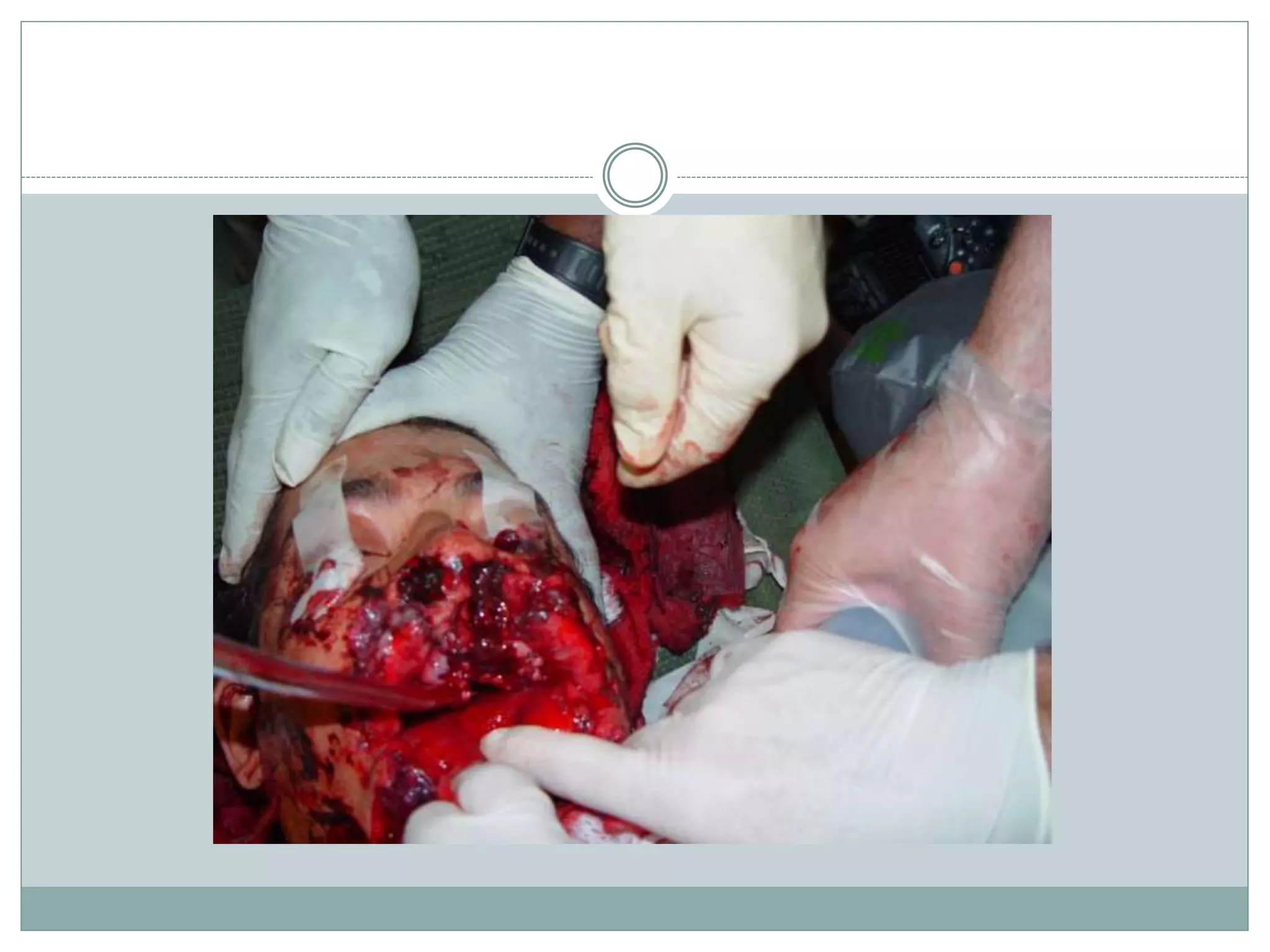 Blast injuries | PPTX