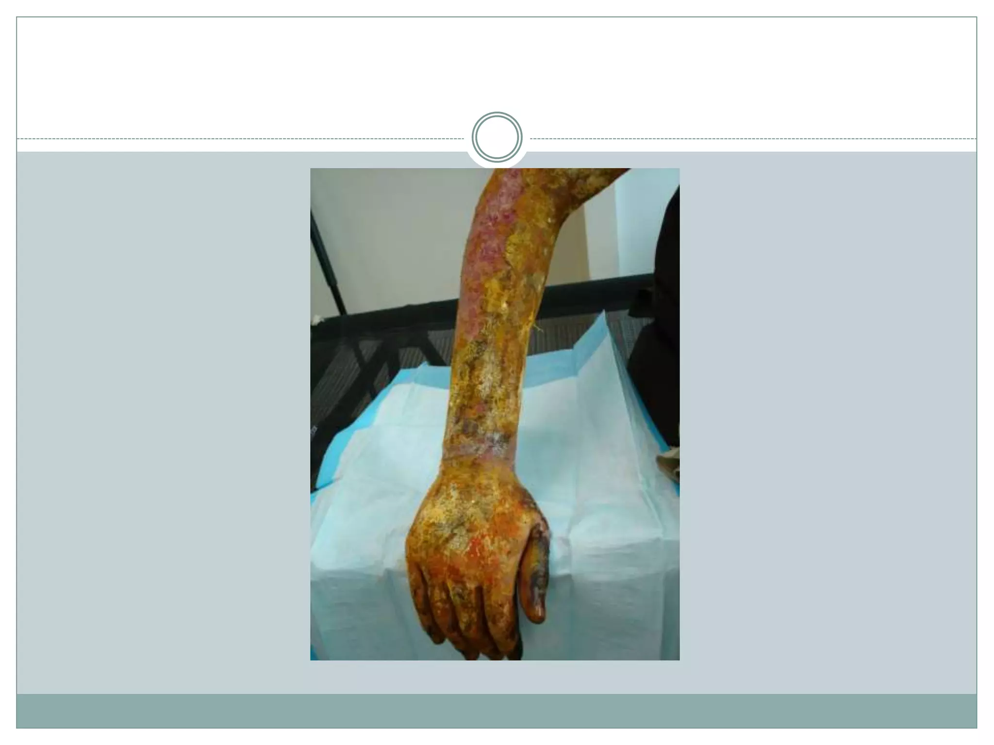 Blast injuries | PPTX