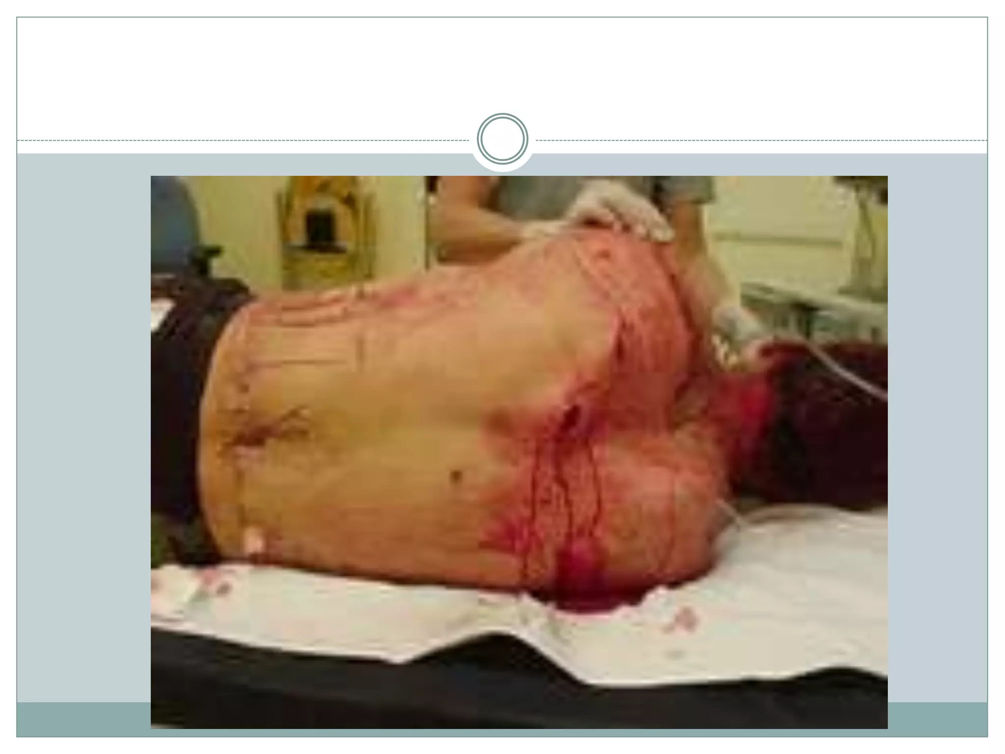 Blast injuries | PPTX