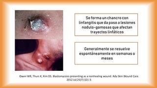 Blastomicosis | PPTX