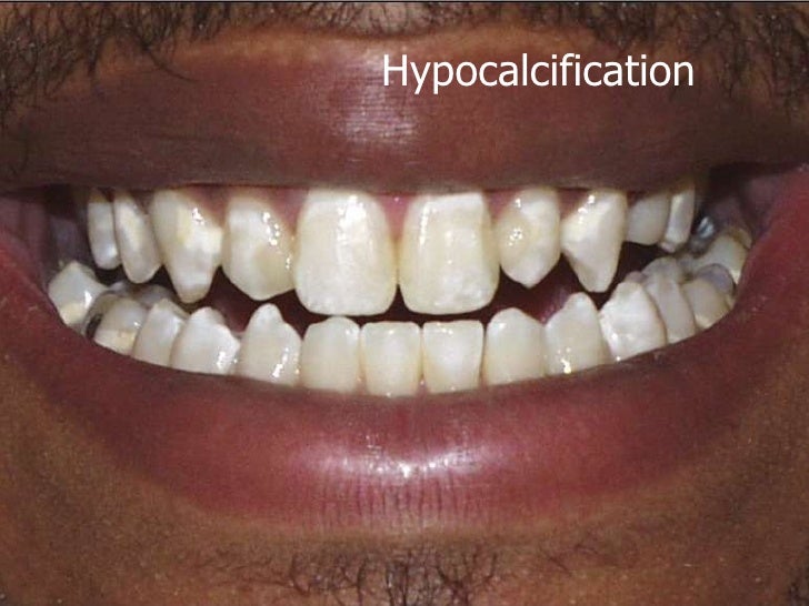 Bleaching Of Discolored Teeth Bleaching Of Discolored Teeth