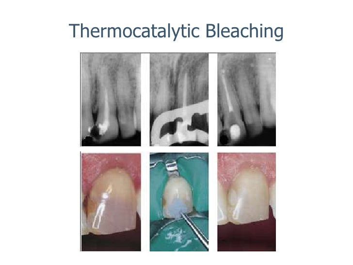 Bleaching Of Discolored Teeth