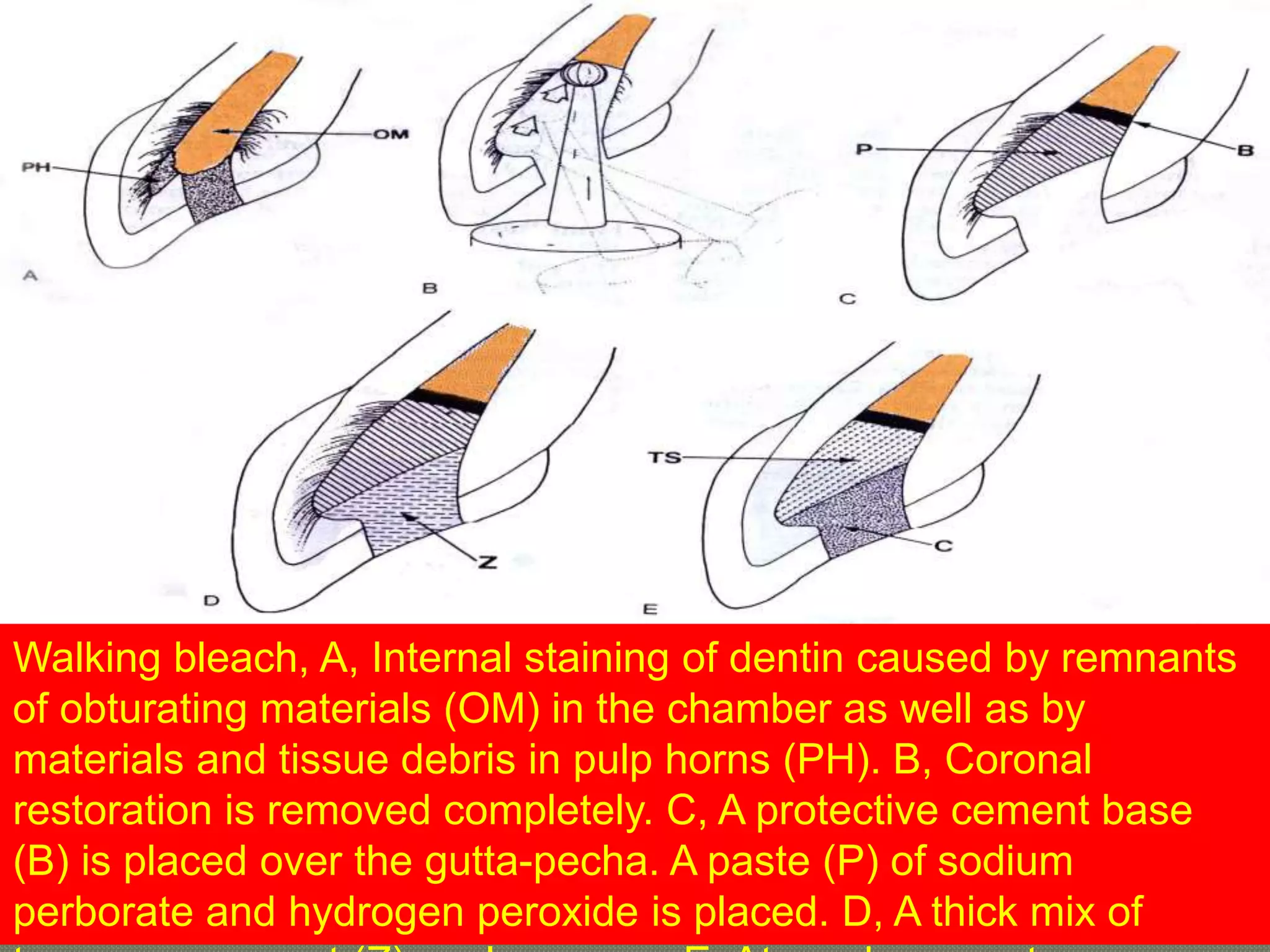 Bleaching of non vital teeth | PPTX