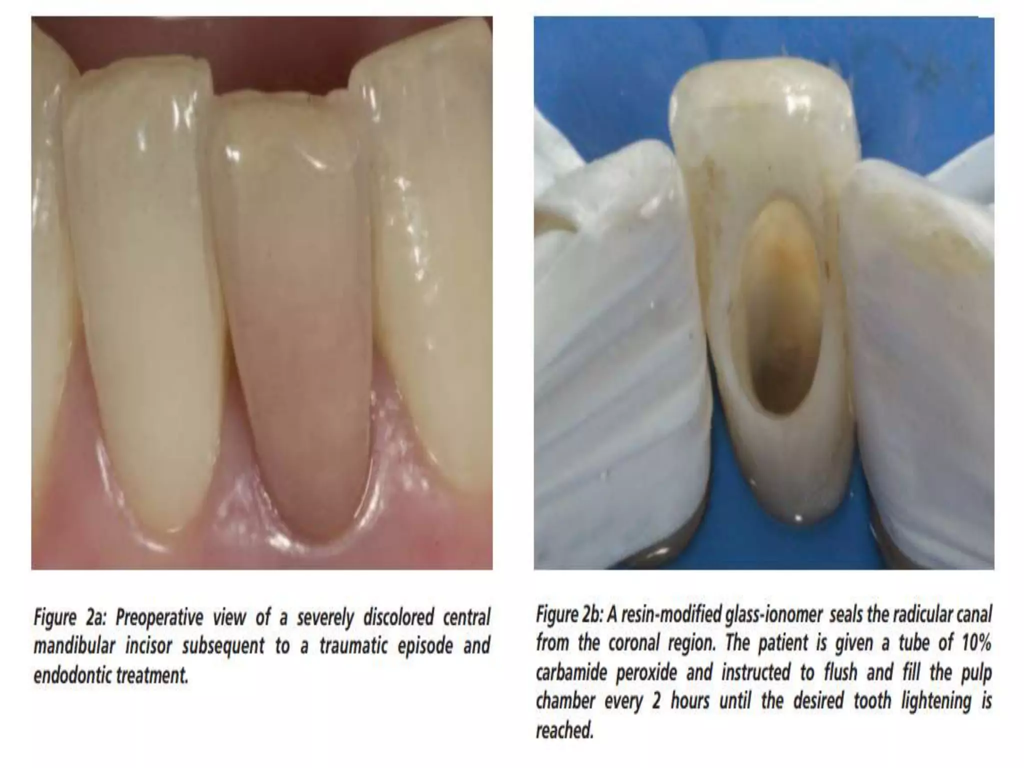 Bleaching of non vital teeth | PPTX