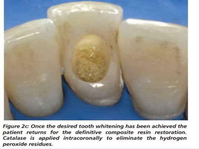 Bleaching of non vital teeth