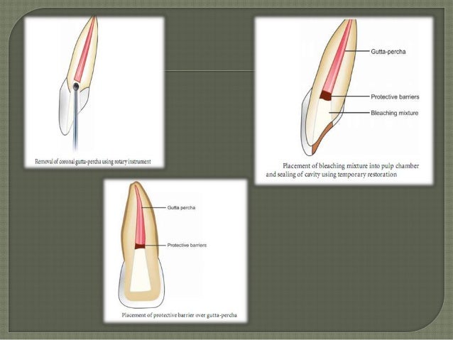 Bleaching of non vital teeth