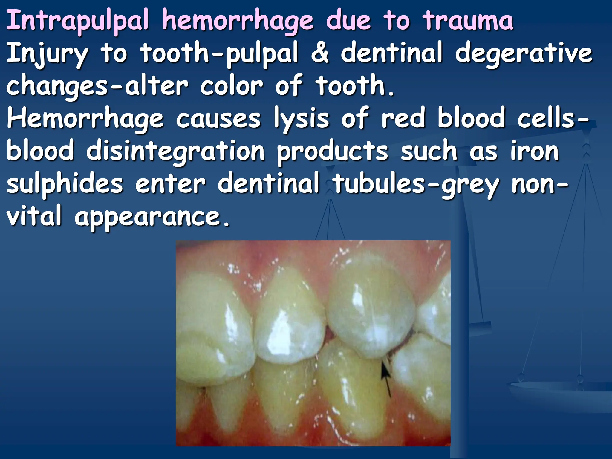 BLEACHING TECHNIQUES IN RESTORATIVE DENTISTRY.pptx Whitening of root ...