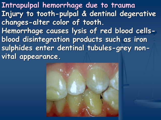 BLEACHING TECHNIQUES IN RESTORATIVE DENTISTRY.pptx Whitening of root ...