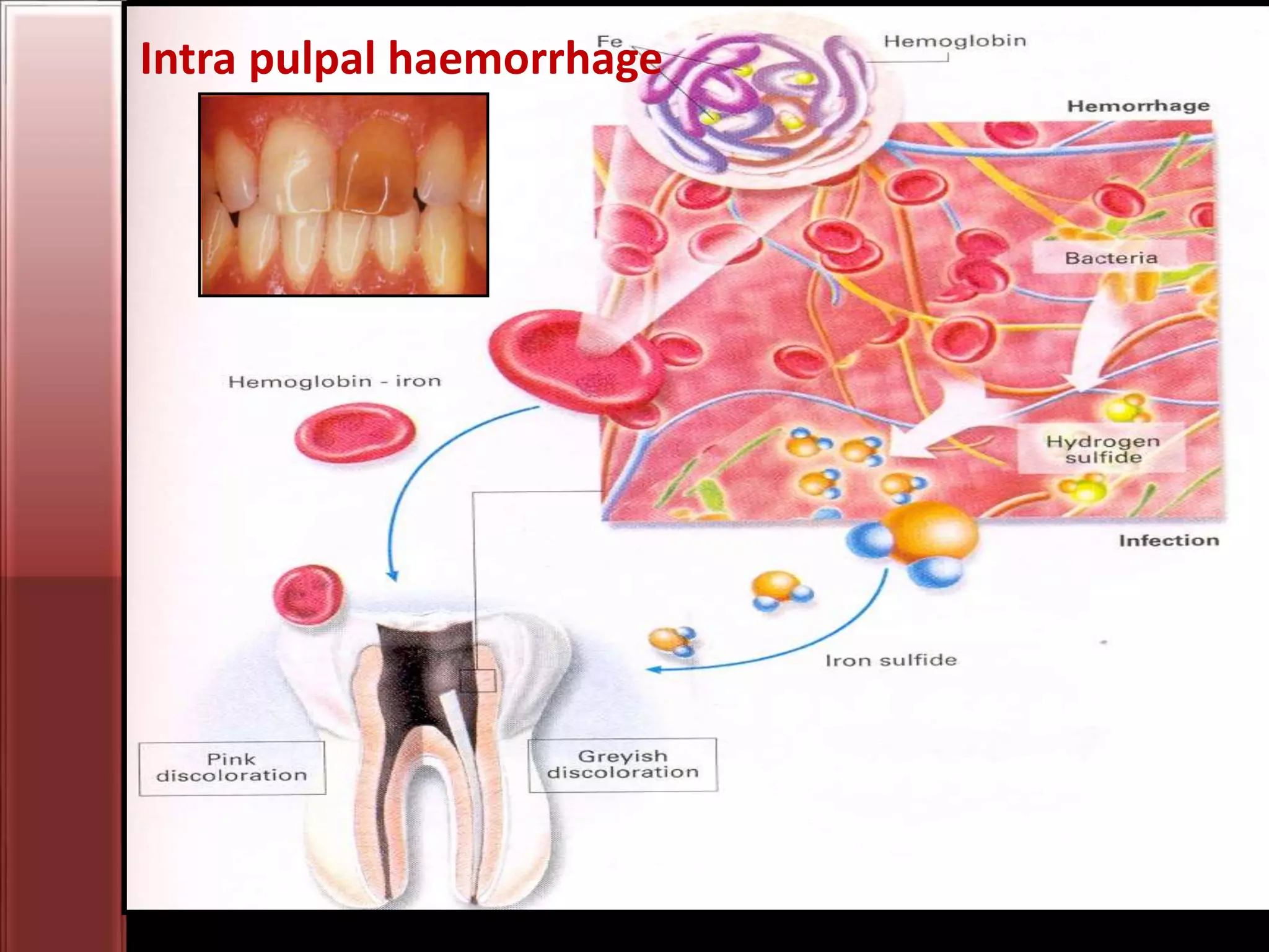 Bleaching | PPTX | Dental Health | Diseases and Conditions