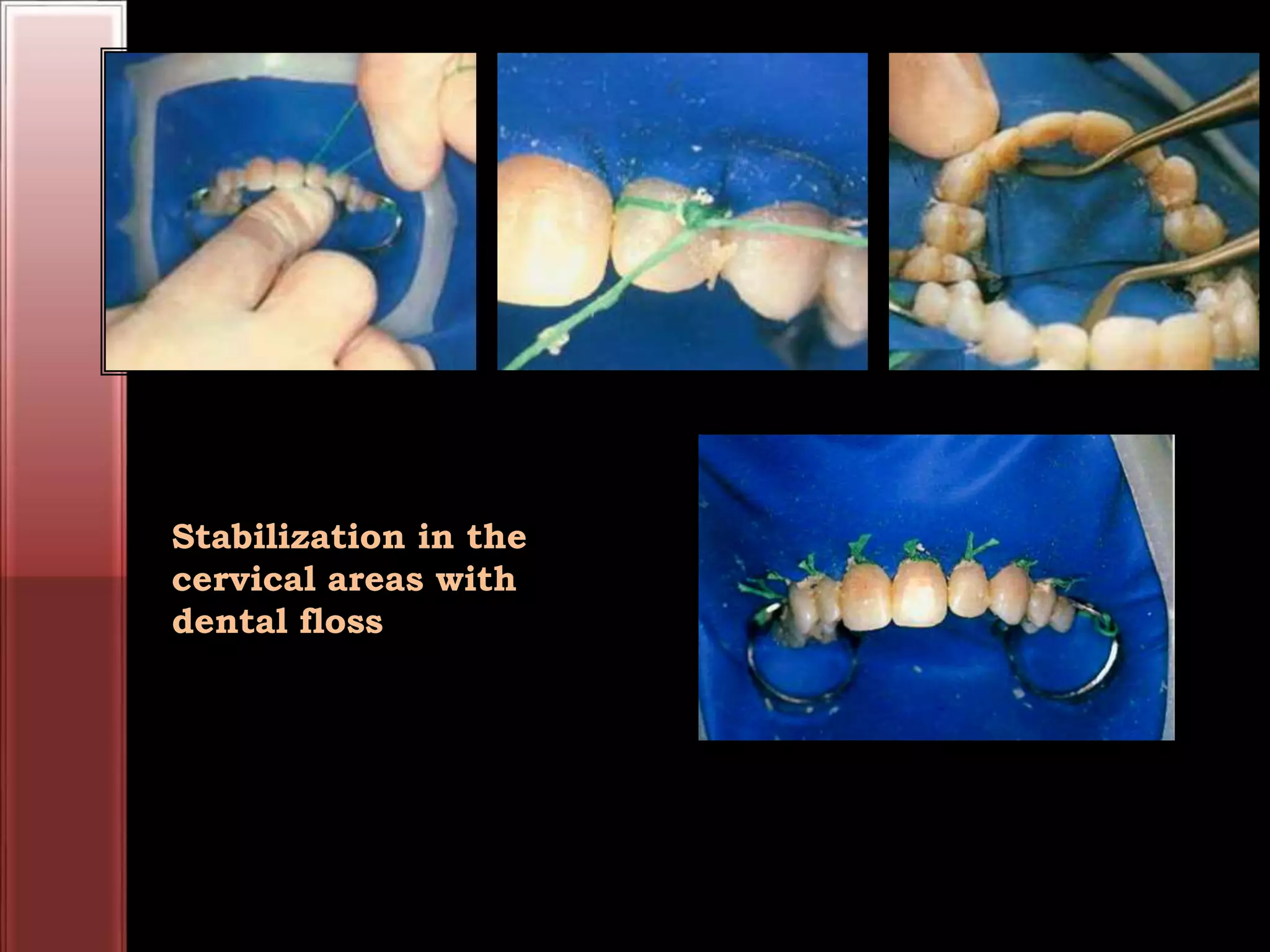 Bleaching | PPTX | Dental Health | Diseases and Conditions