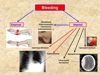 Bleeding. blood loss. bleeding compensation in eliminating the ...
