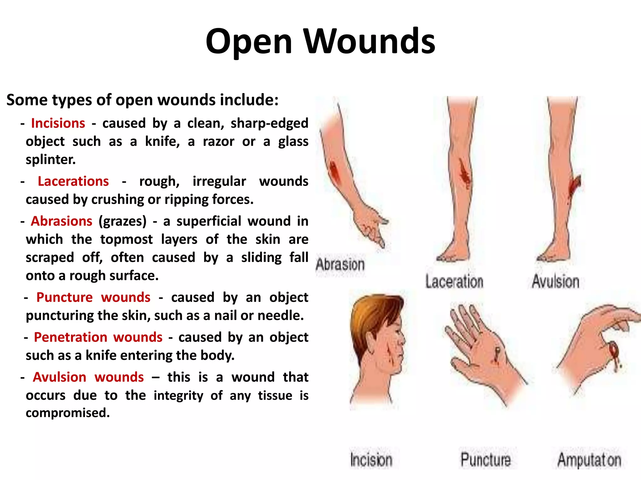 Controlling External Bleeding | PPTX