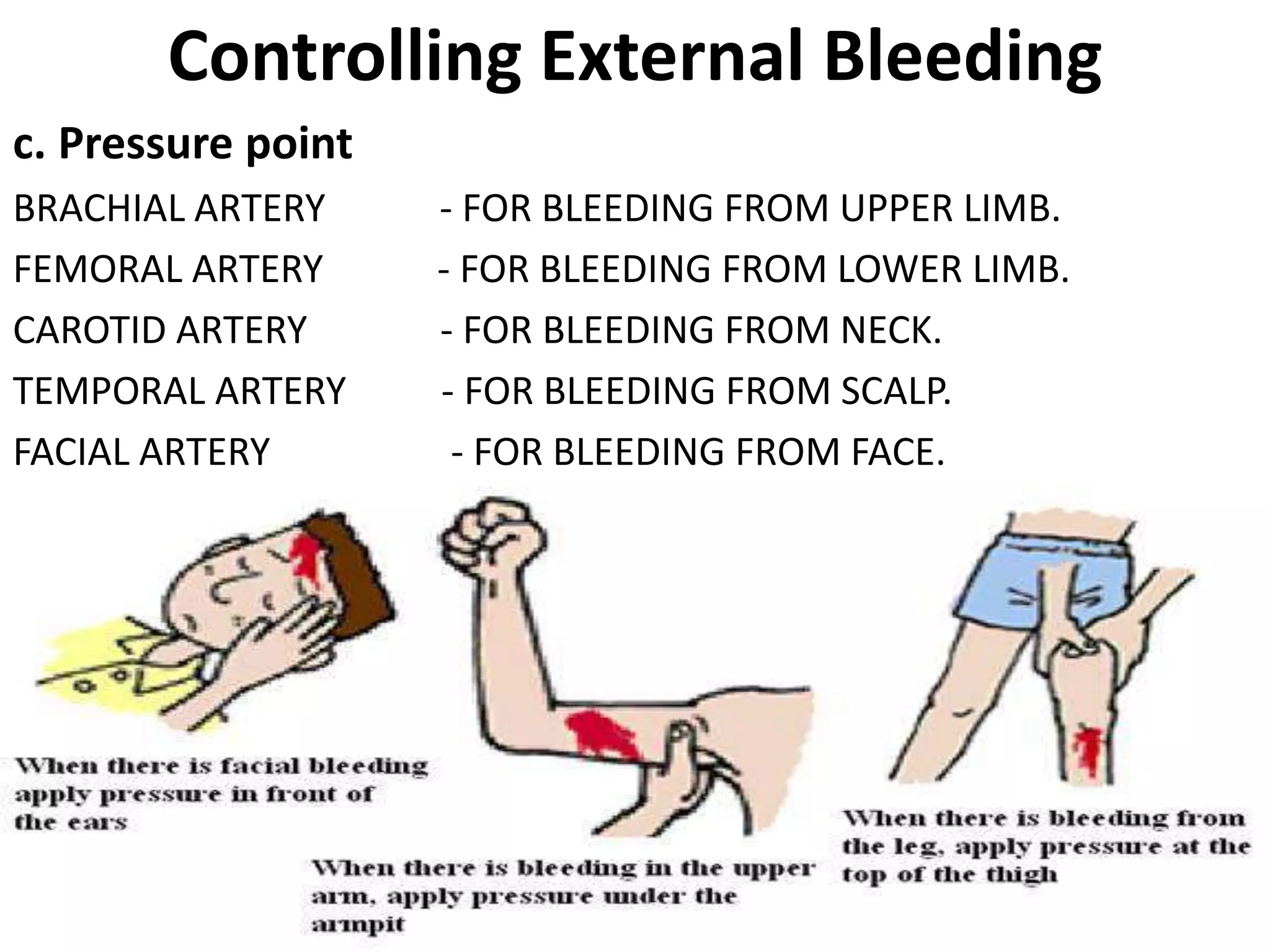 Controlling External Bleeding | PPTX | First Aid | Injuries