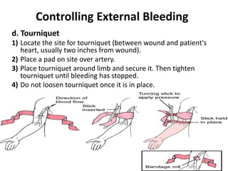 Controlling External Bleeding | PPTX