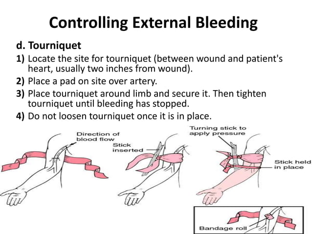 Controlling External Bleeding