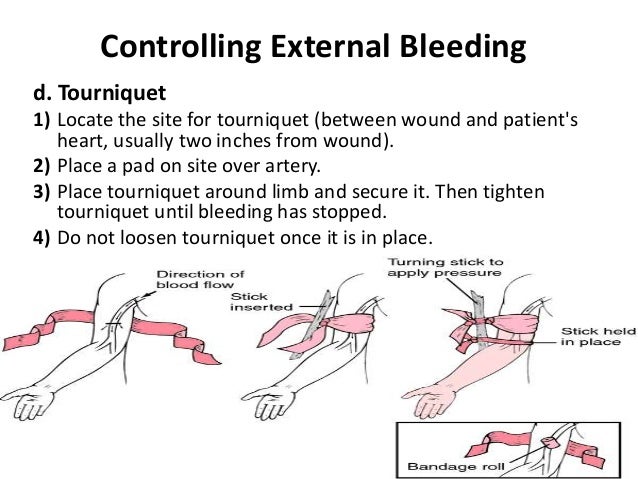 Controlling External Bleeding