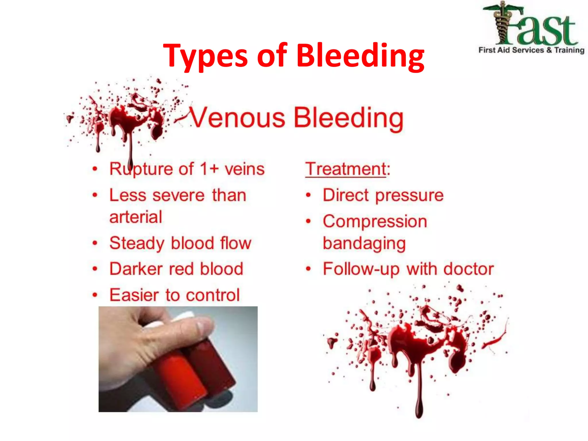 Bleeding | PPT