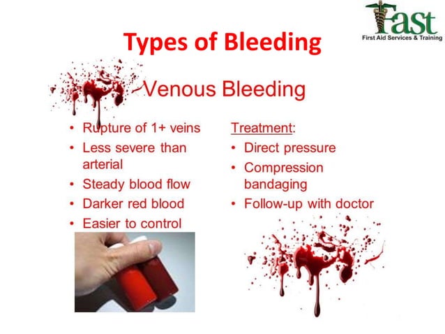 Bleeding | PPT