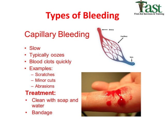 Bleeding | PPT