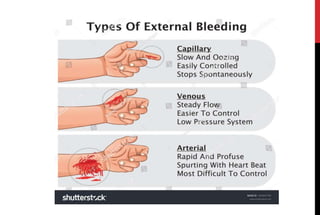 BLEEDING (2).pptx | First Aid | Injuries