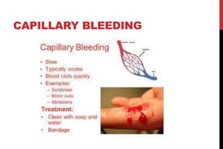 BLEEDING (2).pptx | First Aid | Injuries