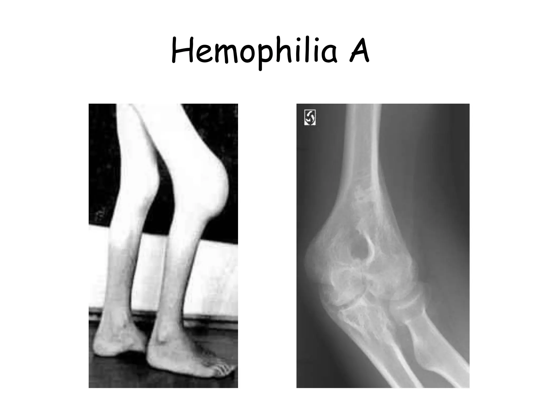Bleeding and clotting disorders in children | PPTX