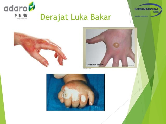 Bleeding control.pptx