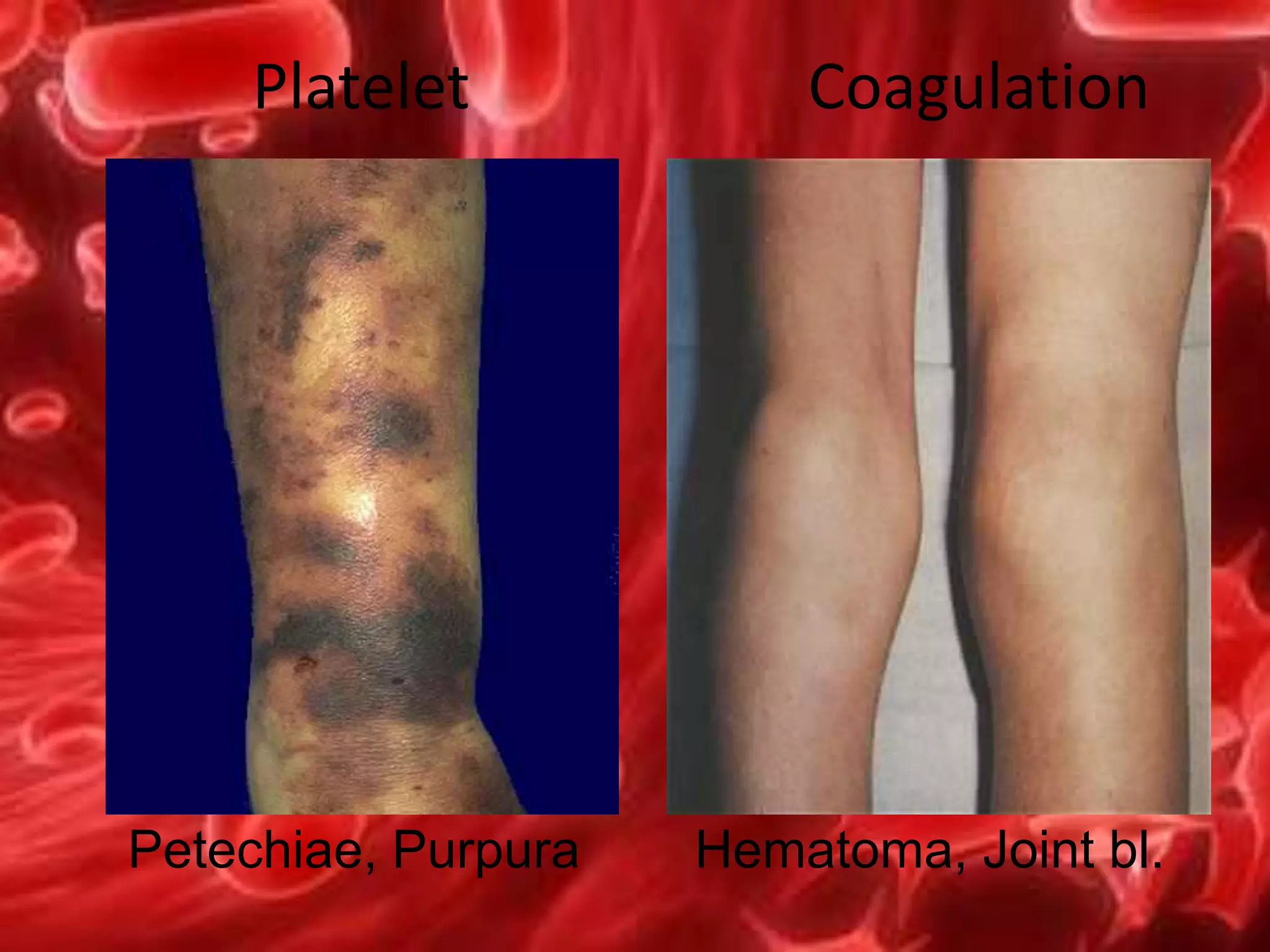 Bleeding diathesis dr . Thamir alotaify | PPTX