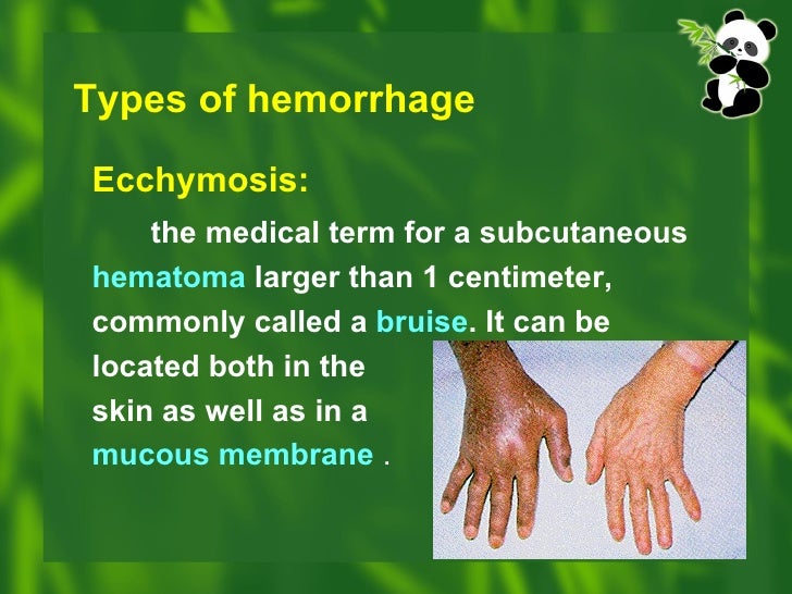 Ecchymosis Vs Bruise