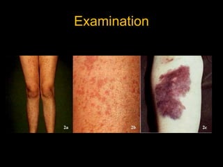 Approach to Bleeding disorder | PPTX