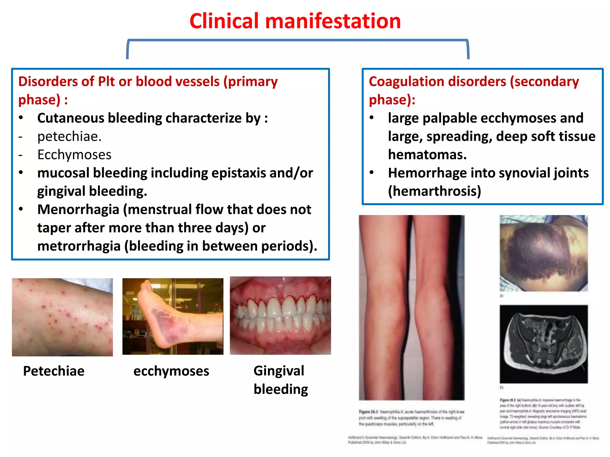 Bleeding disorders | PPTX