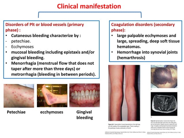 Bleeding disorders | PPTX