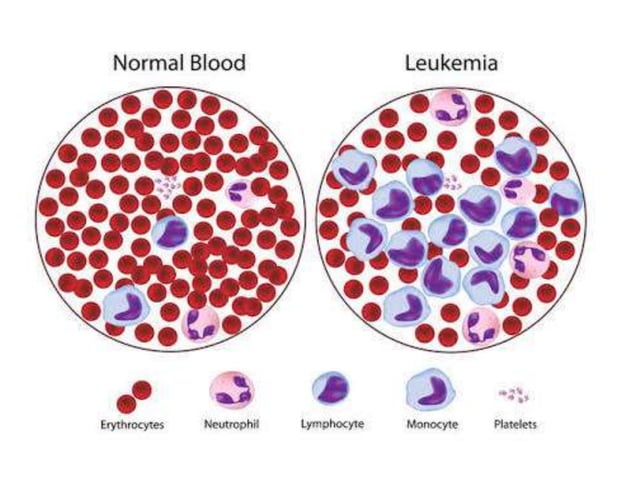 Leukemia in children | PPTX | Blood Disorders | Diseases and Conditions