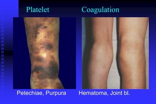 different bleeding_disorders presentation | PPT