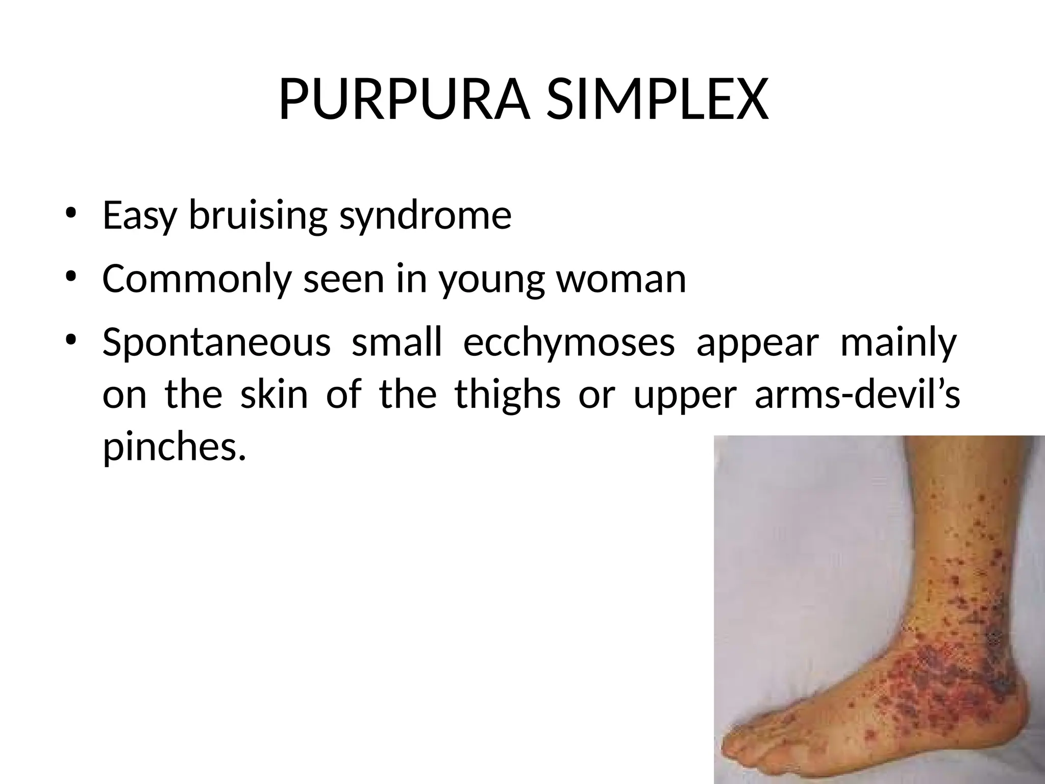 bleeding disorders- classification, vascular abnormalities.pptx