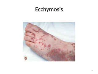 bleeding disorders- classification, vascular abnormalities.pptx