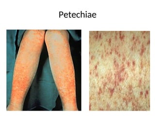 bleeding disorders- classification, vascular abnormalities.pptx