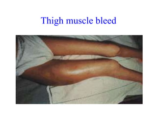 bleeding disorders4th 1.ppt