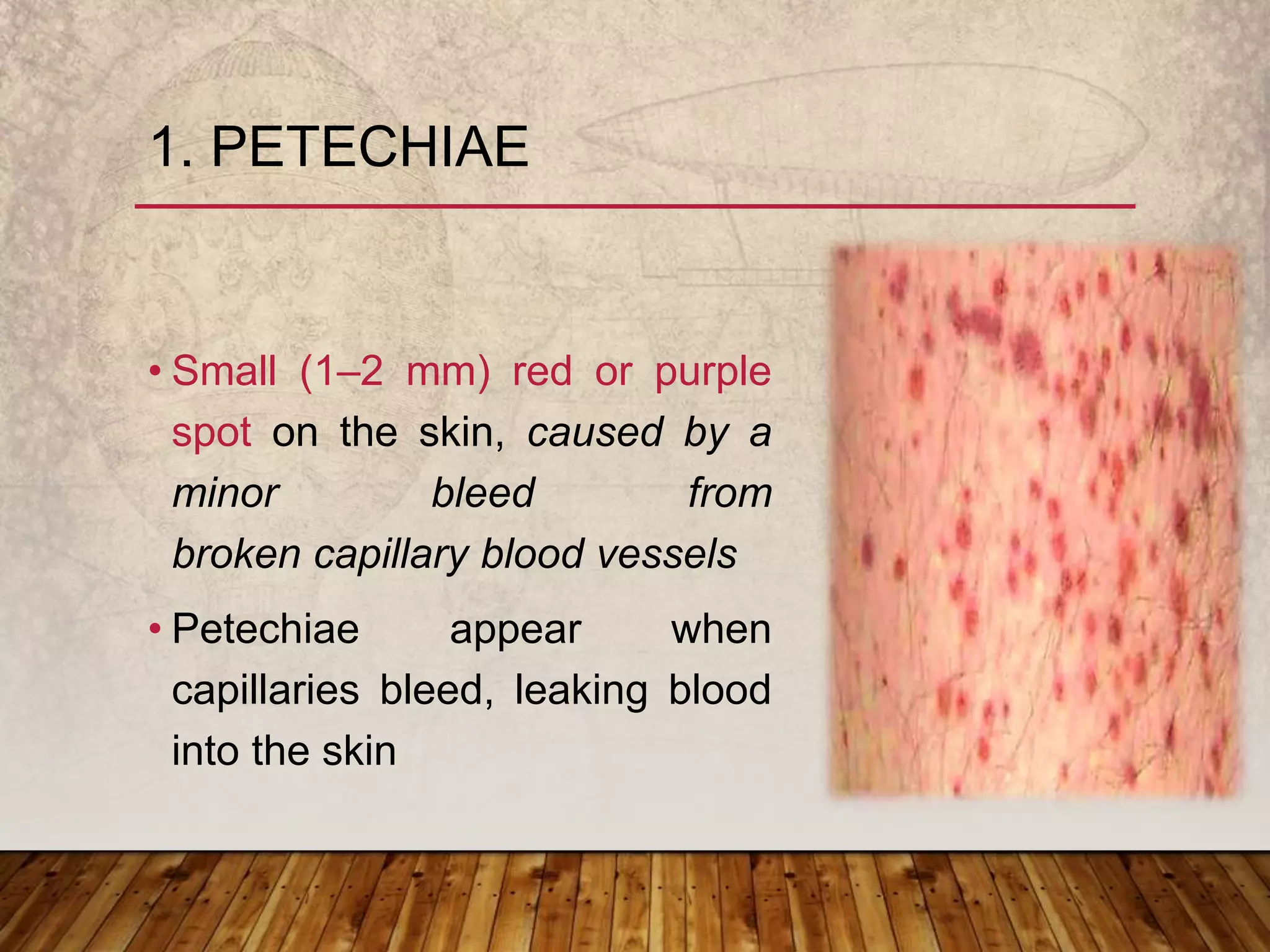 Bleeding disorders and their management | PPTX