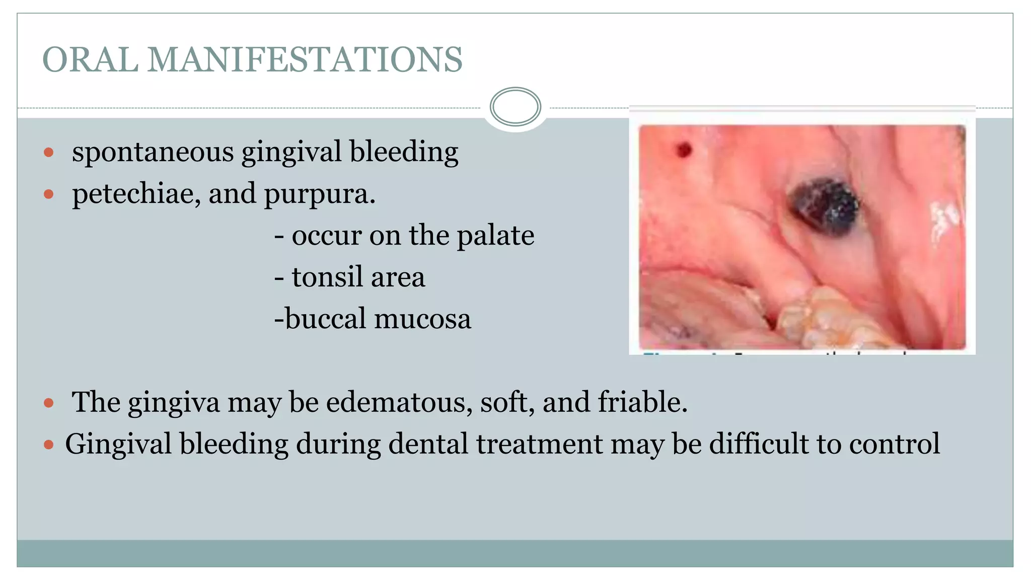 Dental Management of Patients with Bleeding Disorders | PPTX