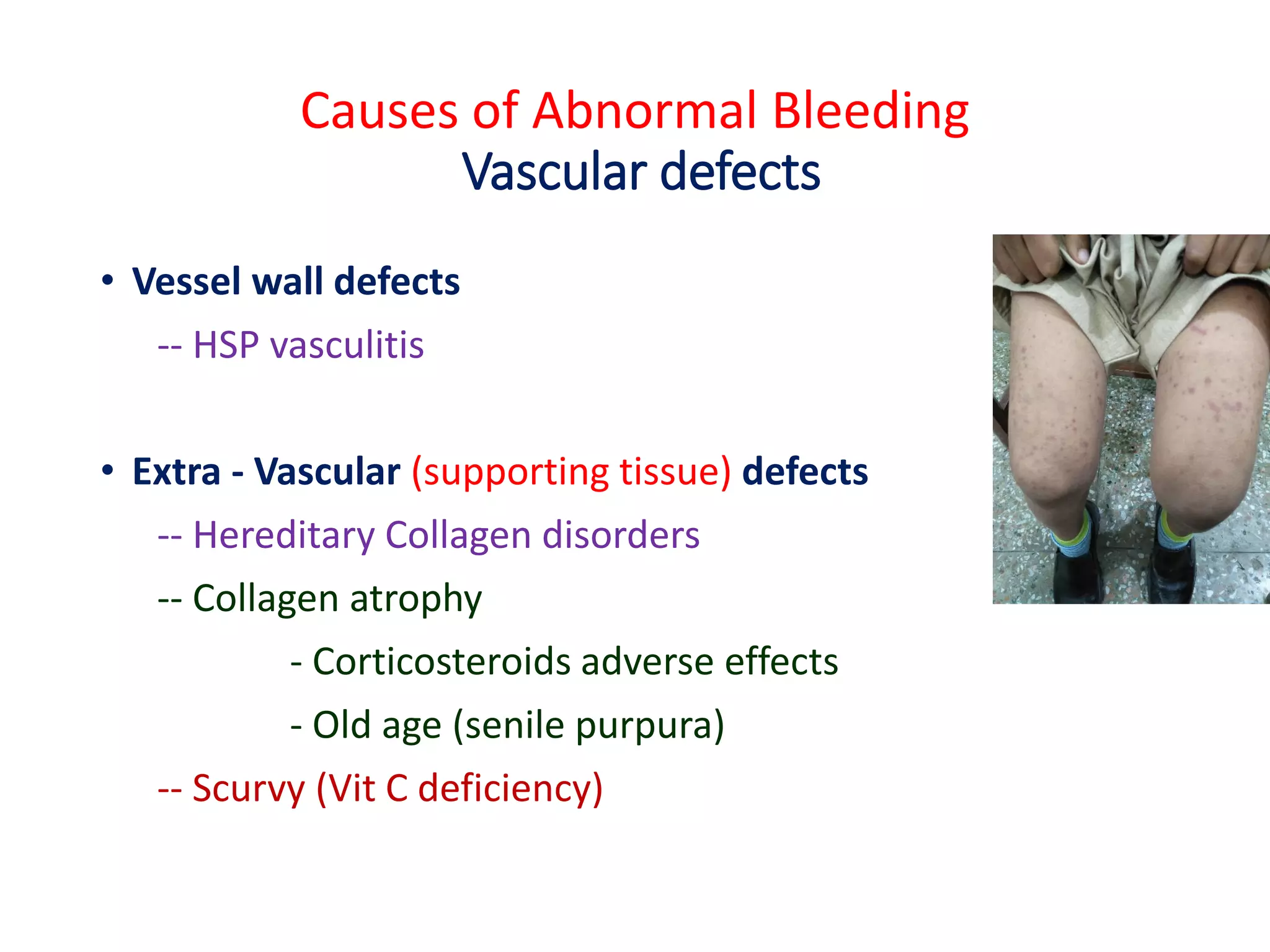 Bleeding disorders in children 2021 | PDF