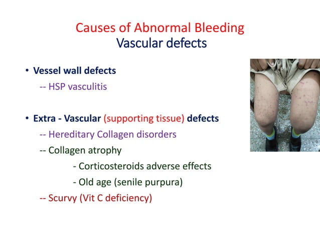 Bleeding disorders in children 2021 | PDF