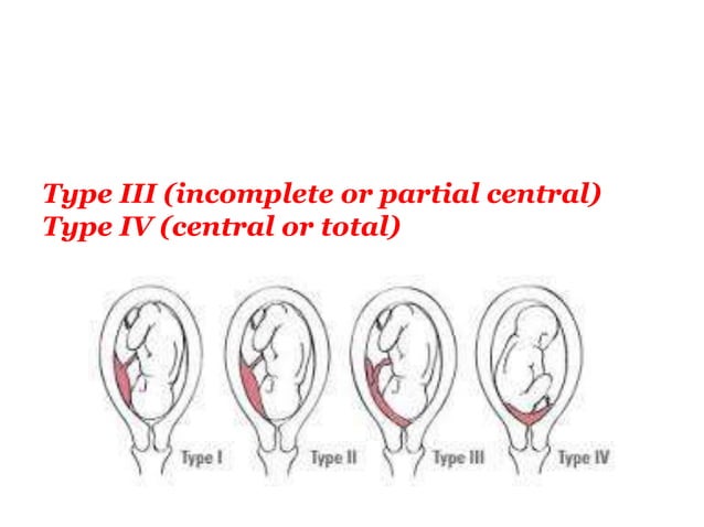 BLEEDING DISORDERS IN LATE PREGNANCY-Renjini.R....pptx
