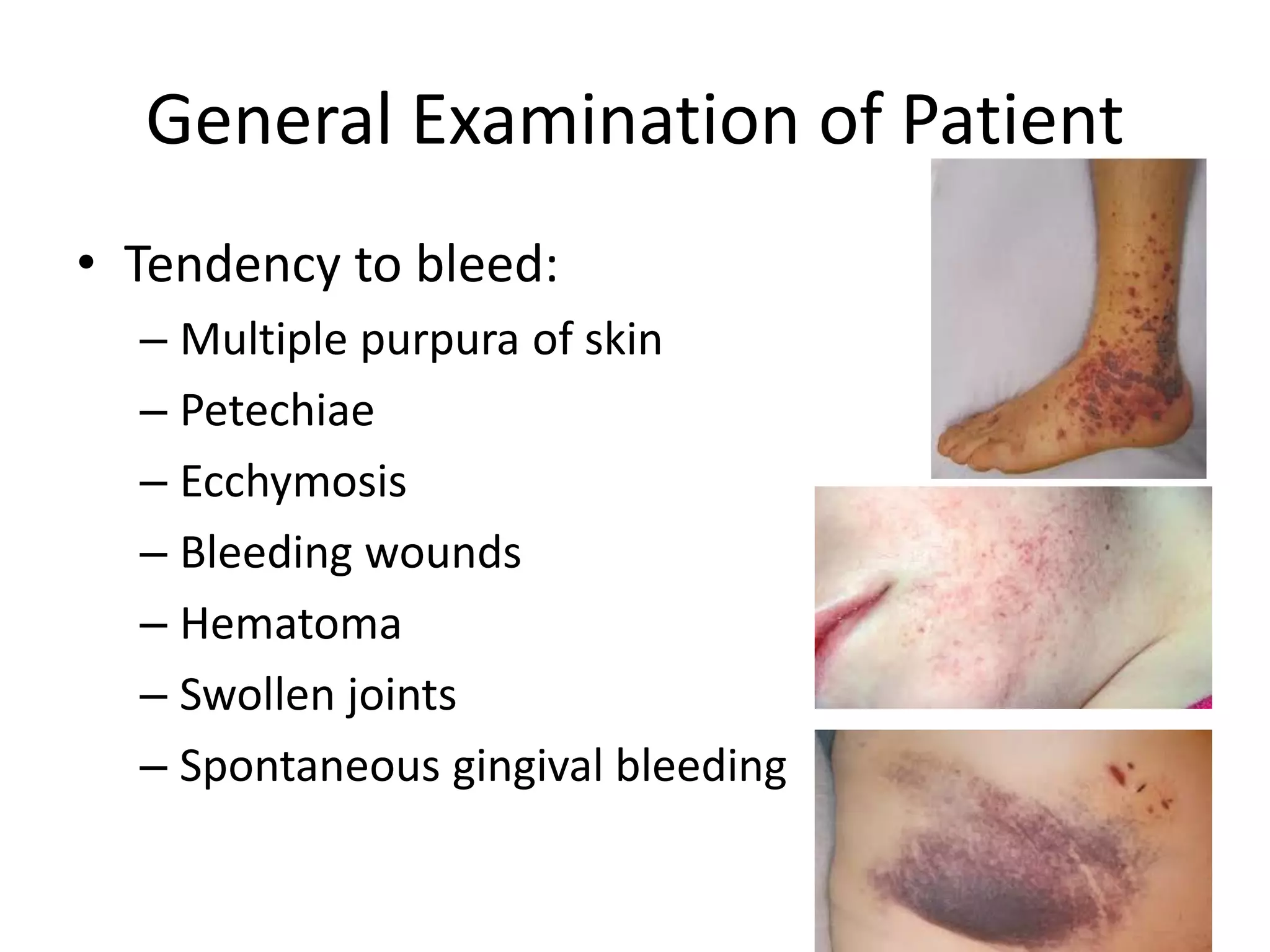 Bleeding Disorders in Primary Dental Care | PDF