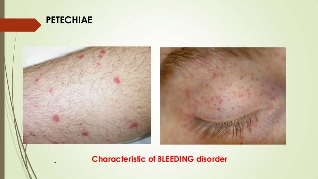 Bleeding disorders(Disorders of Platelets and vessel wall)