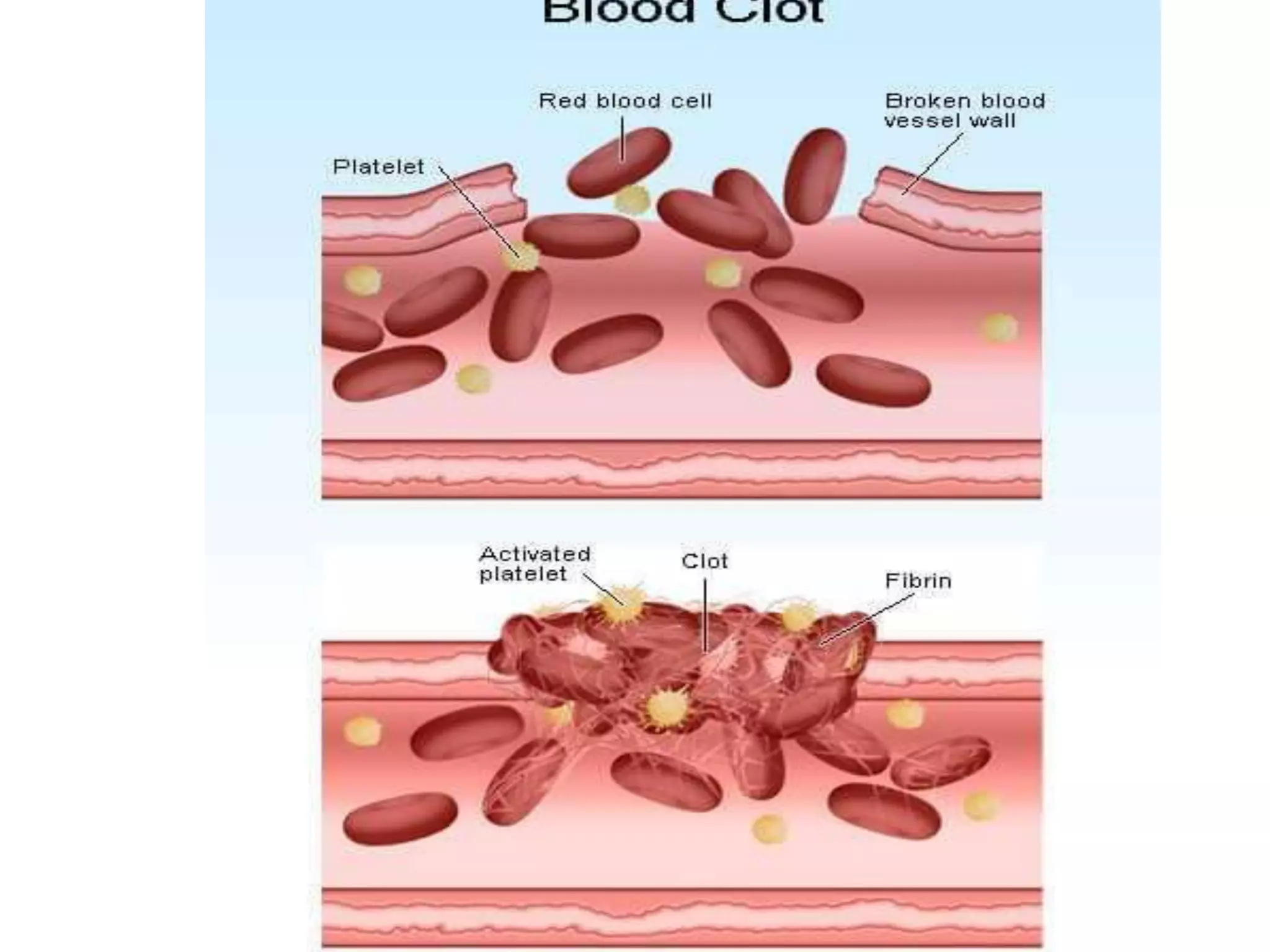BLEEDING DISORDERSSS.pptx | Blood Disorders | Diseases and Conditions