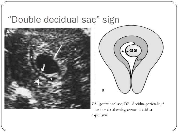 Pregnancy Decidual Bleeding