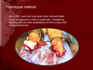 bleedingmanagement-131212142748-phpapp01.pdf