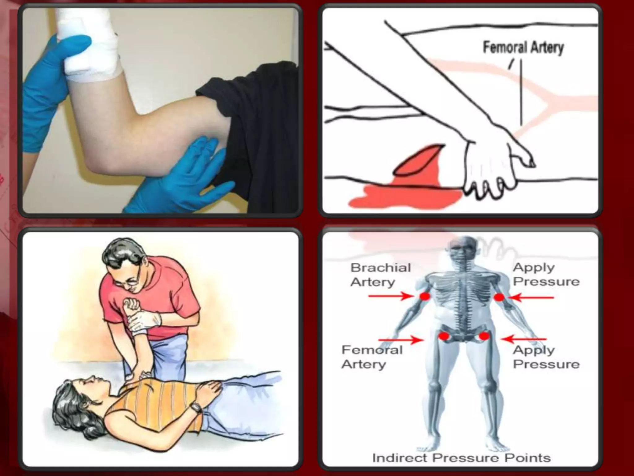 Bleeding management | PPTX